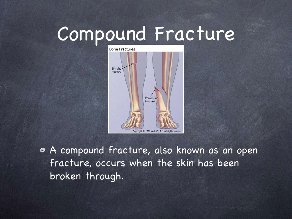 Comminuted, Simple, and Compound Fractures