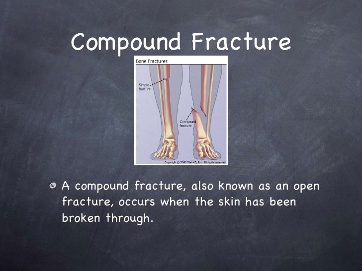 Comminuted fracture causes - terysocial