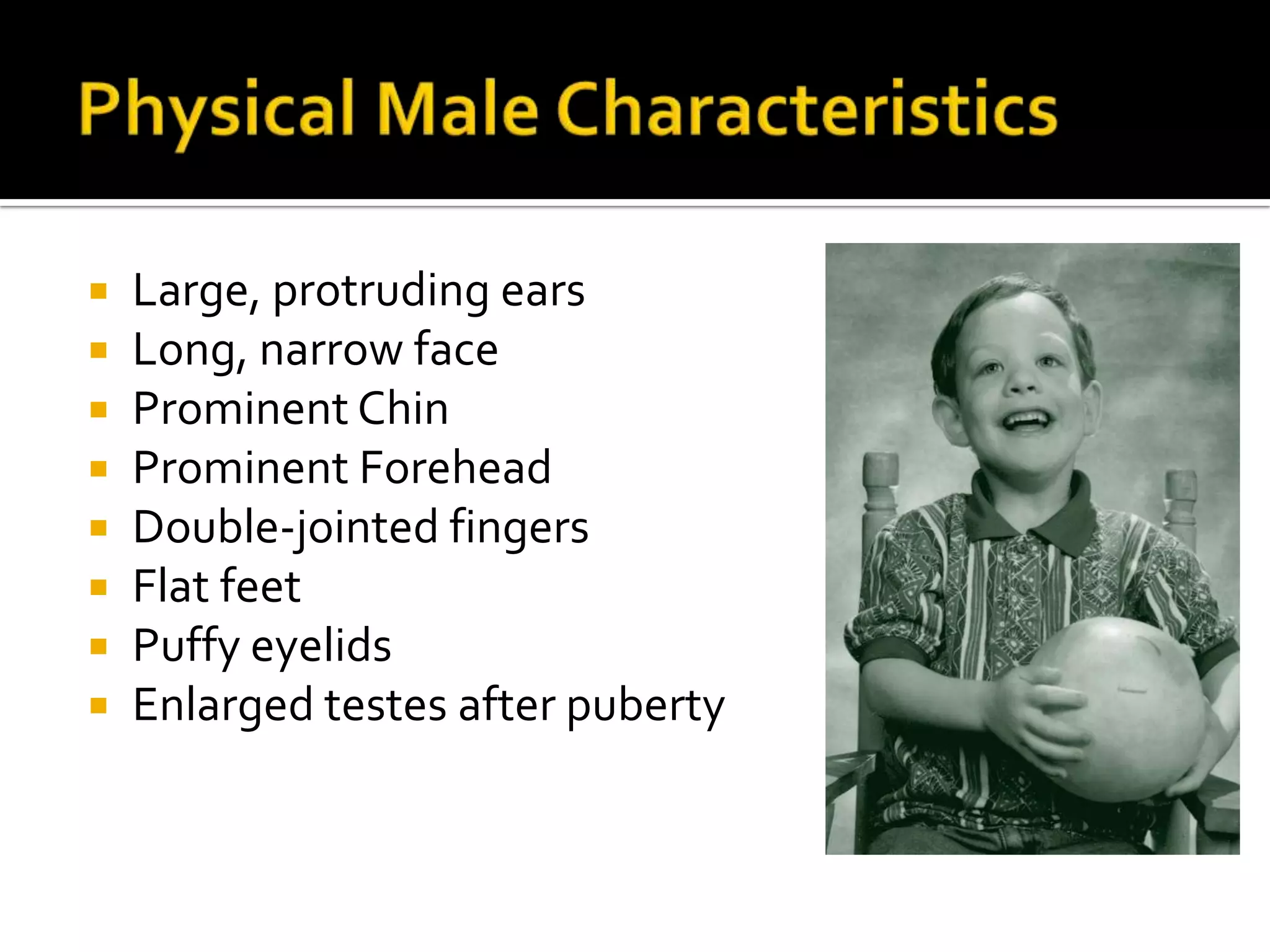 Fragile X Syndrome | PPTX