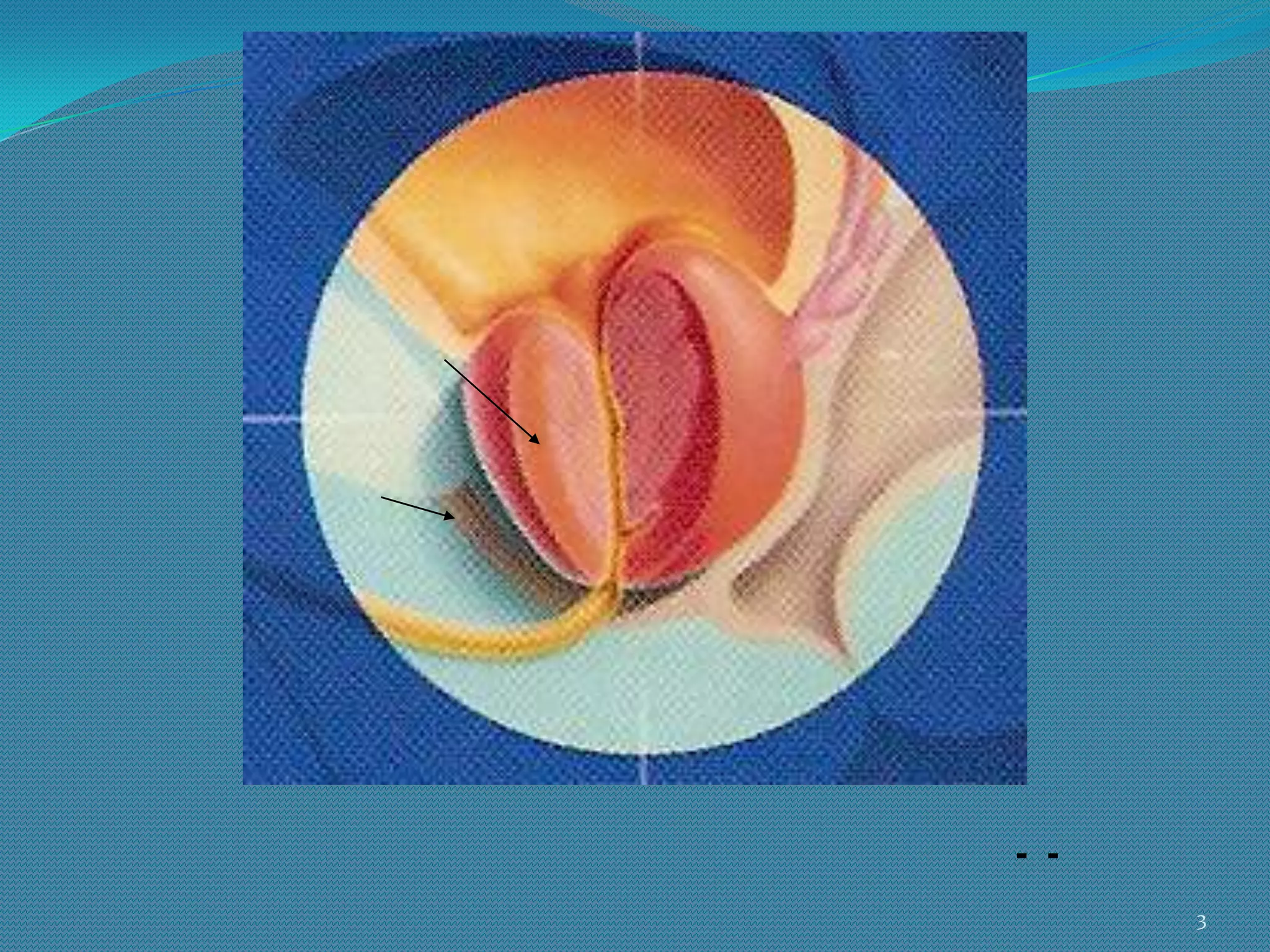 Benign Prostatic Enlargement (BPE) | PPT