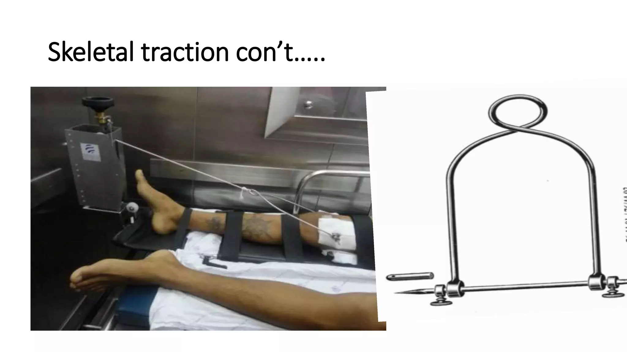 indication and contra-indication cast & traction | PPTX