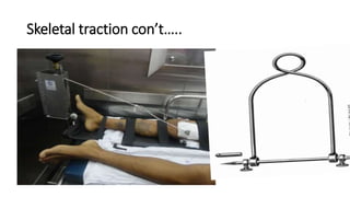 indication and contra-indication cast & traction | PPTX