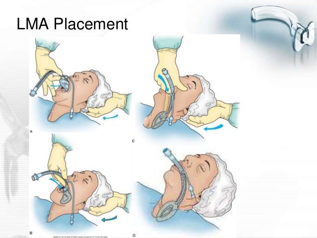 Power point airway management