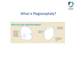 Plagiocephaly Information for Parents, Carers and Healthcare ...
