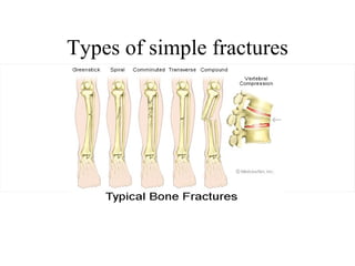 Powerpoint 2 Fractures | PPT