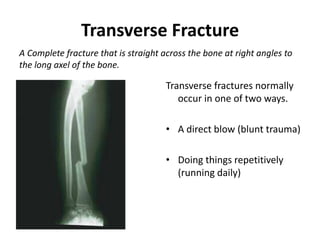 Chosen Fracture Types | PPTX