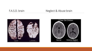 Powerpoint fasd overview 2014 | PPTX | Mental Health | Diseases and ...