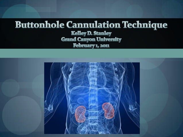 Buttonhole Cannulation Technique Power Point | PPT