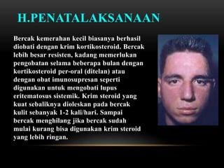 KMB SLE (Sistemik Lupus Eritematosus) | PPTX