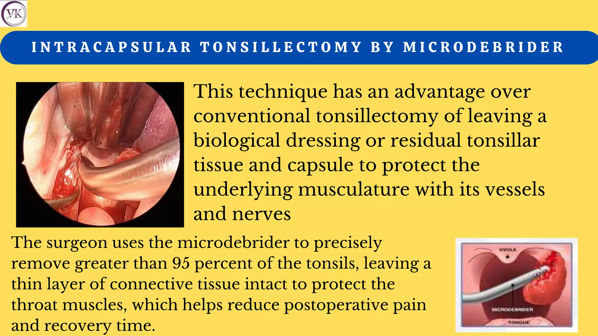 TONSILLECTOMY-INDICATIONS, CONTRAINDICATIONS,METHODS,SURGICAL STEPS AND COMPLICATIONS | PPTX