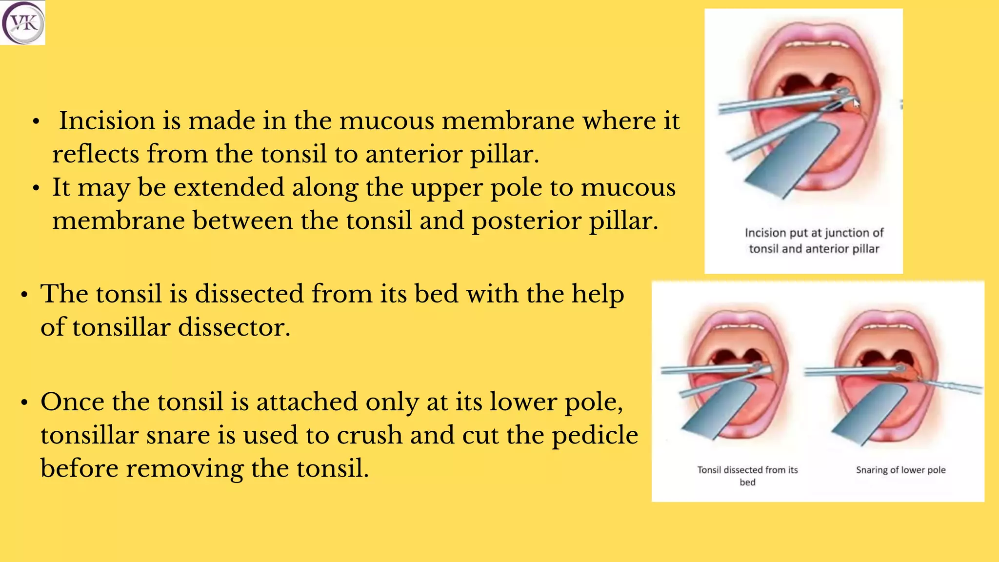 TONSILLECTOMY-INDICATIONS, CONTRAINDICATIONS,METHODS,SURGICAL STEPS AND ...