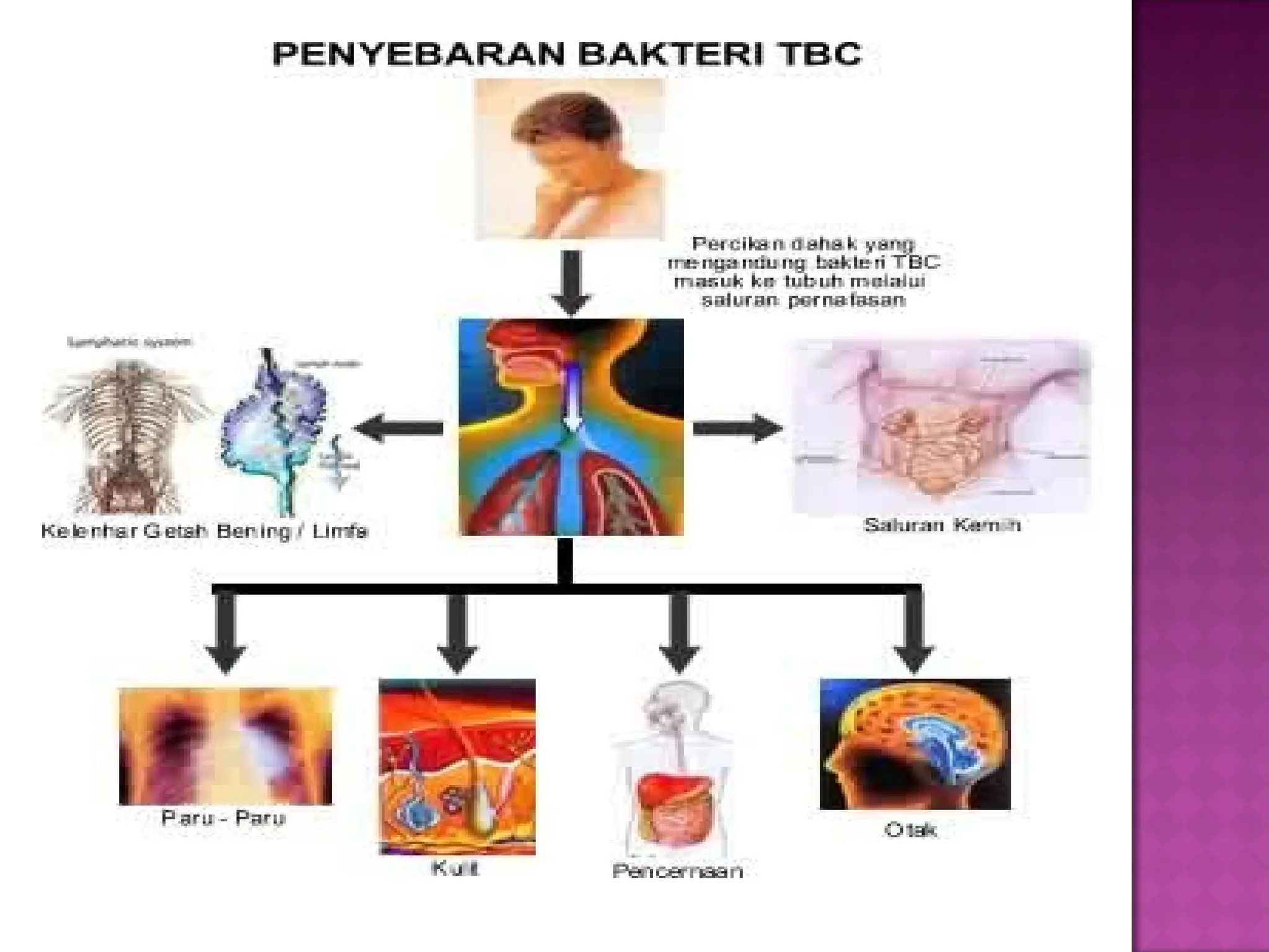 Power point TB Paru penularan dan cara pencegahannya | PPT