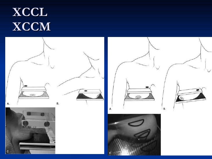 Pozicioniranje U Mamografiji Goran
