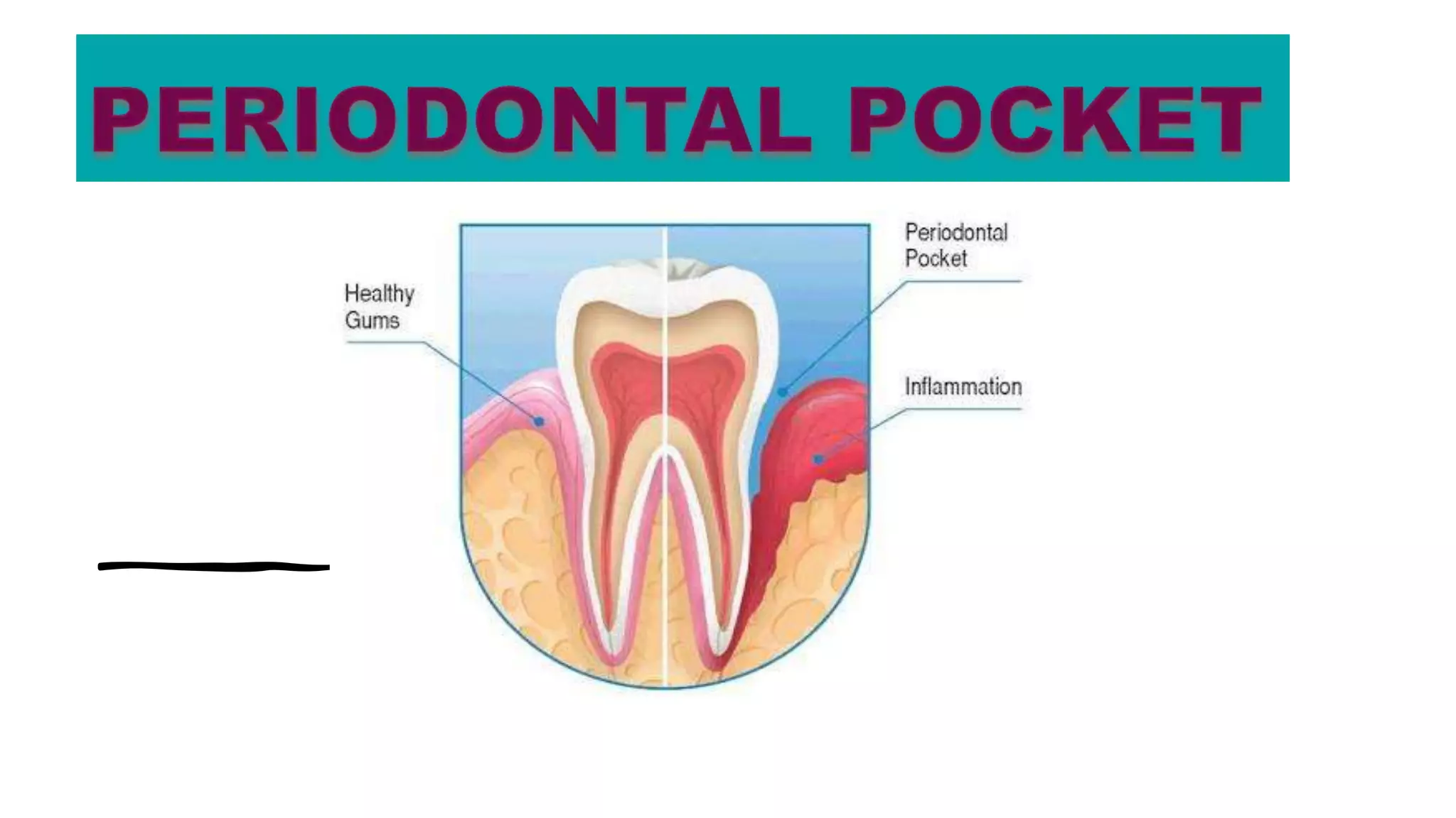 Periodontal pocket | PPTX