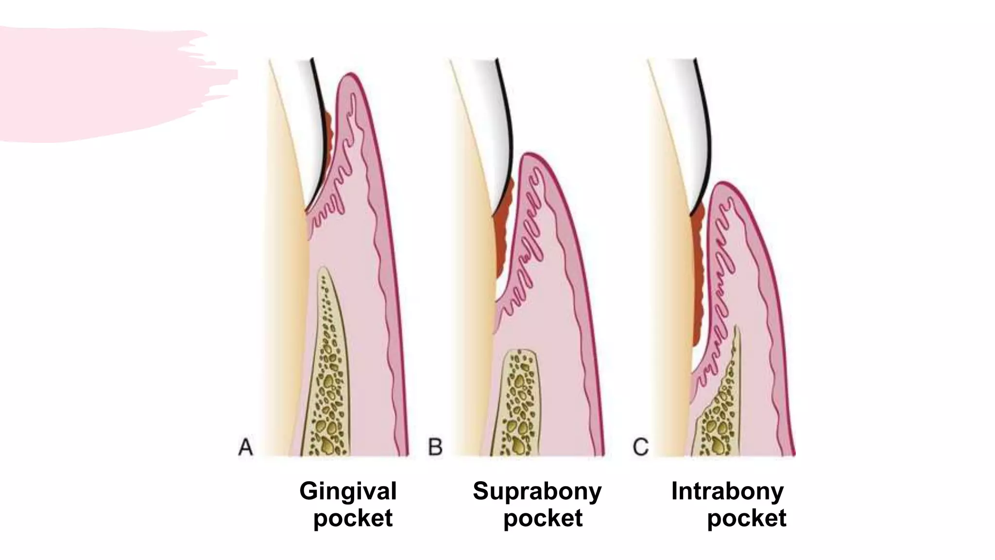 Periodontal pocket | PPTX