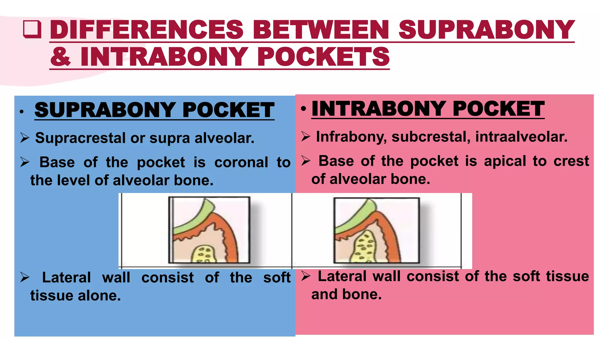 Periodontal pocket | PPTX