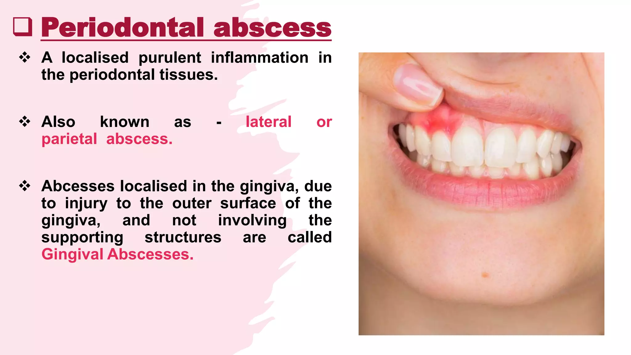 Periodontal pocket | PPTX