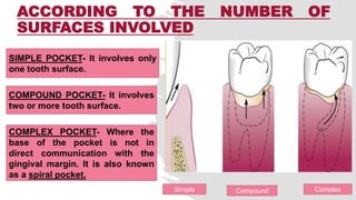 Periodontal pocket | PPTX