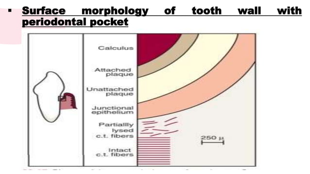 Periodontal pocket | PPTX | Oral care | Personal Care