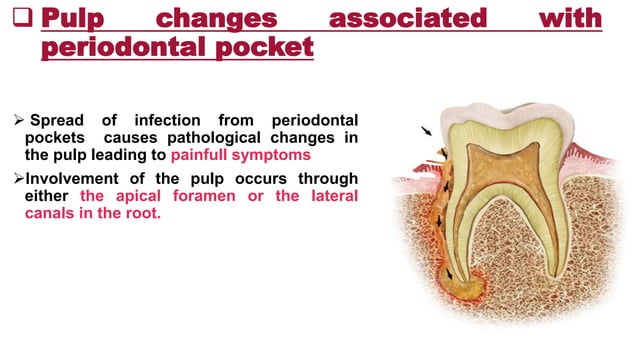 Periodontal pocket | PPTX | Oral care | Personal Care