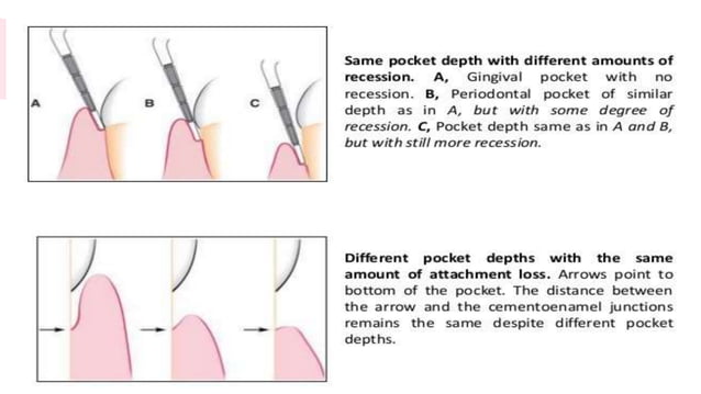 Periodontal pocket | PPTX | Oral care | Personal Care