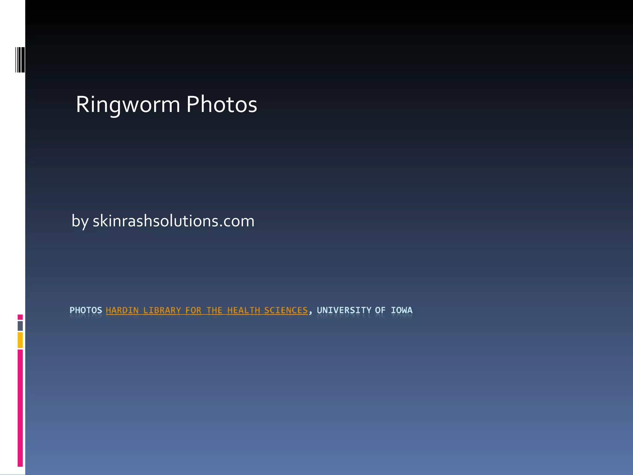 Photos of Ringworm Infections | PPT