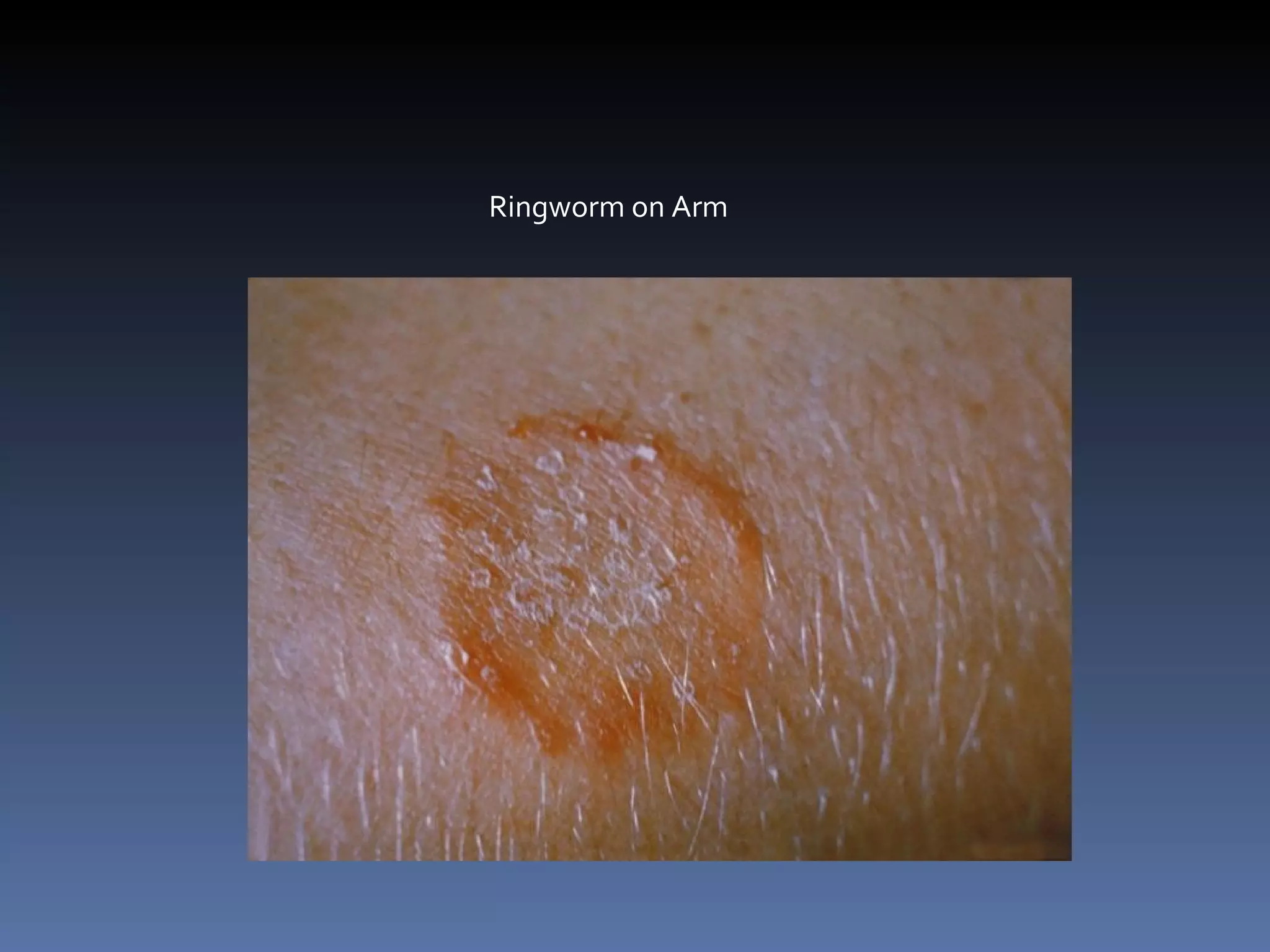 Photos of Ringworm Infections | PPT