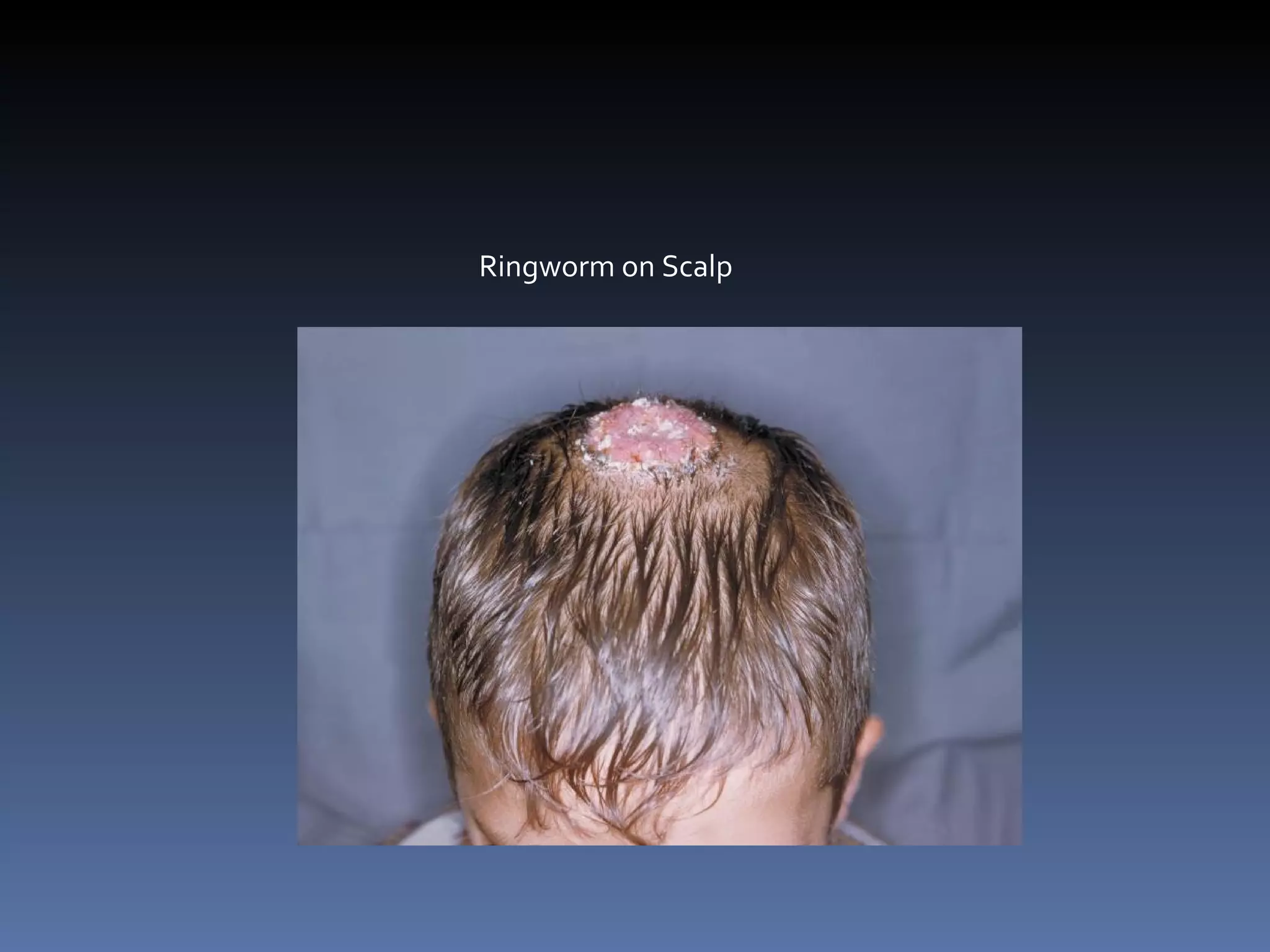 Photos of Ringworm Infections | PPT