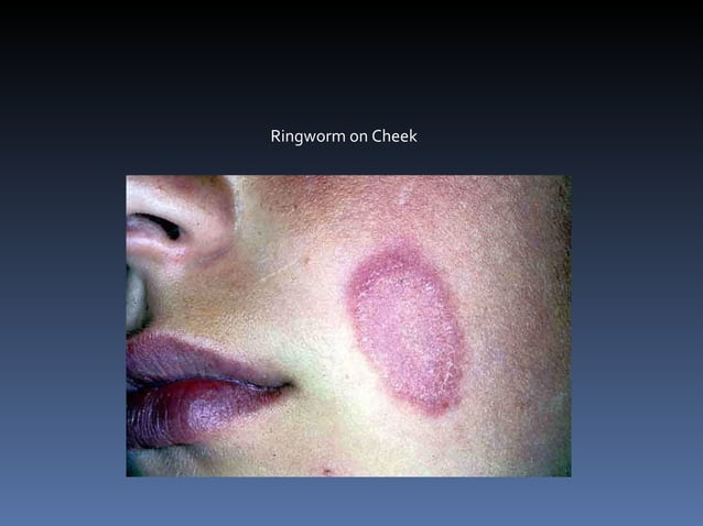 Photos of Ringworm Infections | PPT