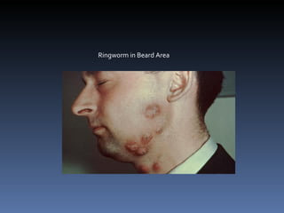 Photos of Ringworm Infections | PPT