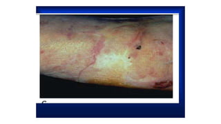 NGUYÊN TẮC SỬ DỤNG CORTICOID | PPT