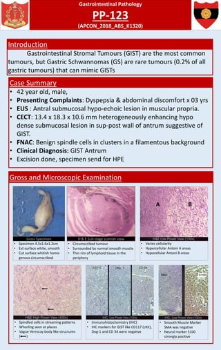 Gastric Schwannoma - A mimic of Gastrointestinal Stromal Tumour | PDF