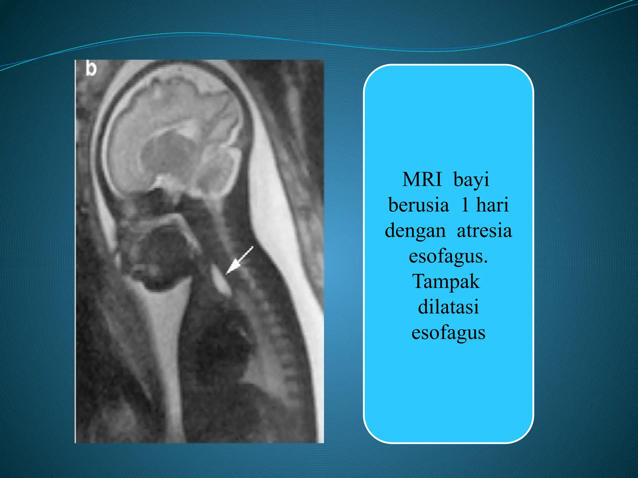 referat radiologi atresia esofagus pada anak | PPT