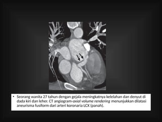Radiologi Aneurisma Arteri Koronaria.pptx