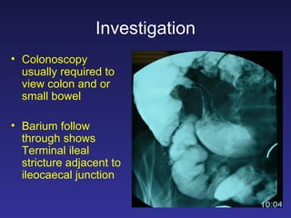 Crohns | PPT