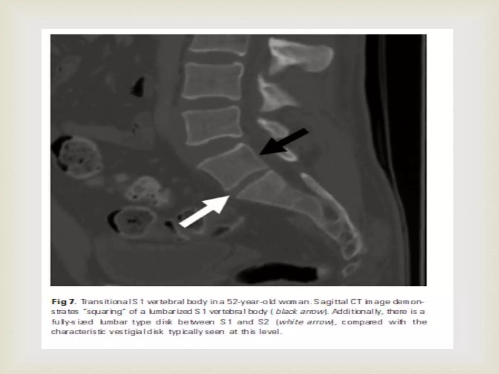 Pp for lumbarization and sacralization by Dr Dhruv Taneja Assistant Professor | PPTX