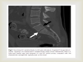 Pp for lumbarization and sacralization by Dr Dhruv Taneja Assistant ...