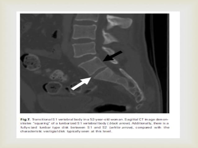 Pp for lumbarization and sacralization by Dr Dhruv Taneja Assistant ...