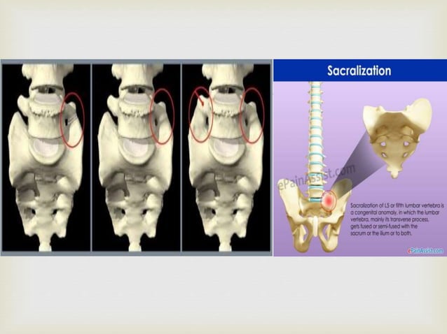 Pp for lumbarization and sacralization by Dr Dhruv Taneja Assistant Professor | PPTX | Death ...