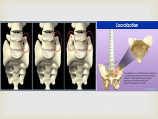 Lumbarization Vs Sacralization