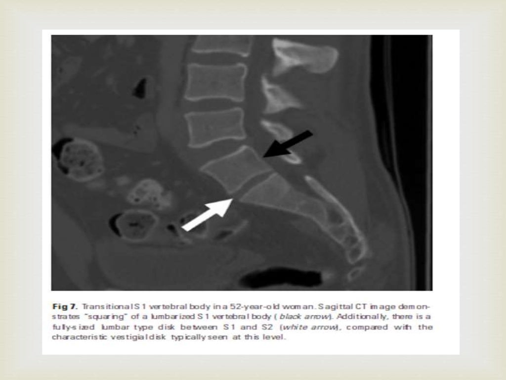 Pp for lumbarization and sacralization by Dr Dhruv Taneja Assistant P…