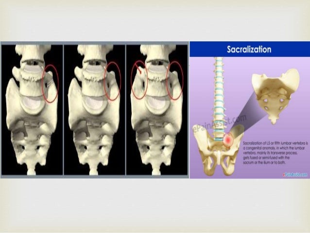 Pp for lumbarization and sacralization by Dr Dhruv Taneja Assistant P…