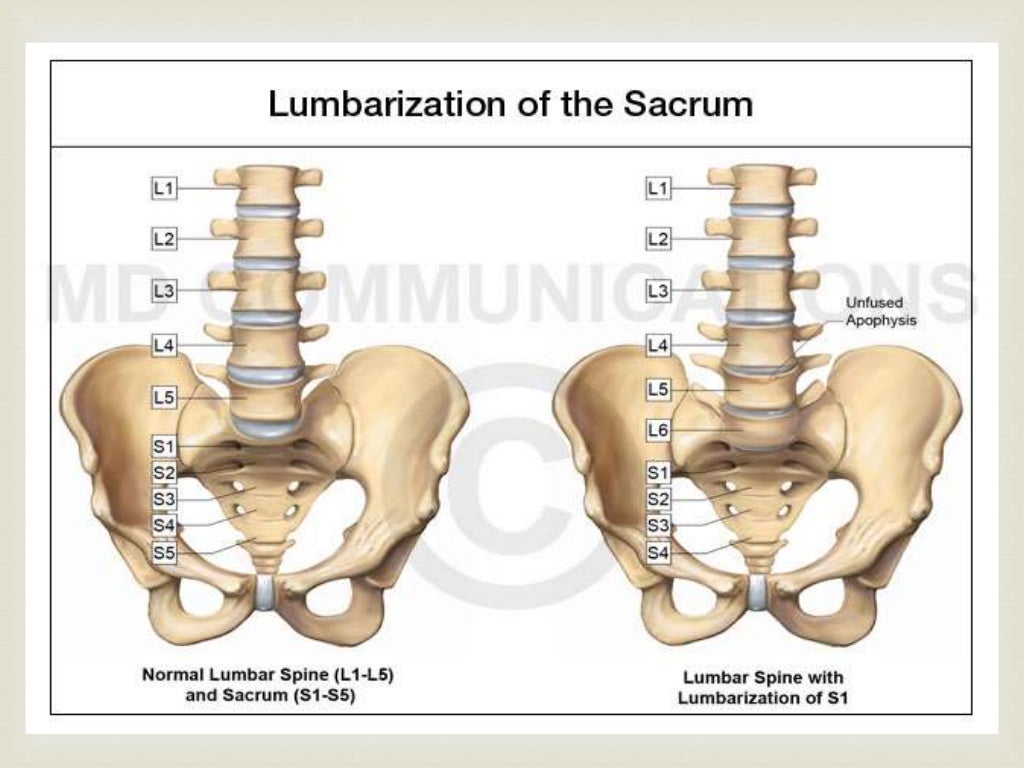 Pp for lumbarization and sacralization by Dr Dhruv Taneja Assistant P…