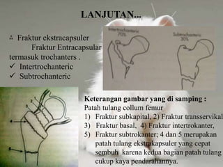 Ppt. fraktur collum femur | PPTX