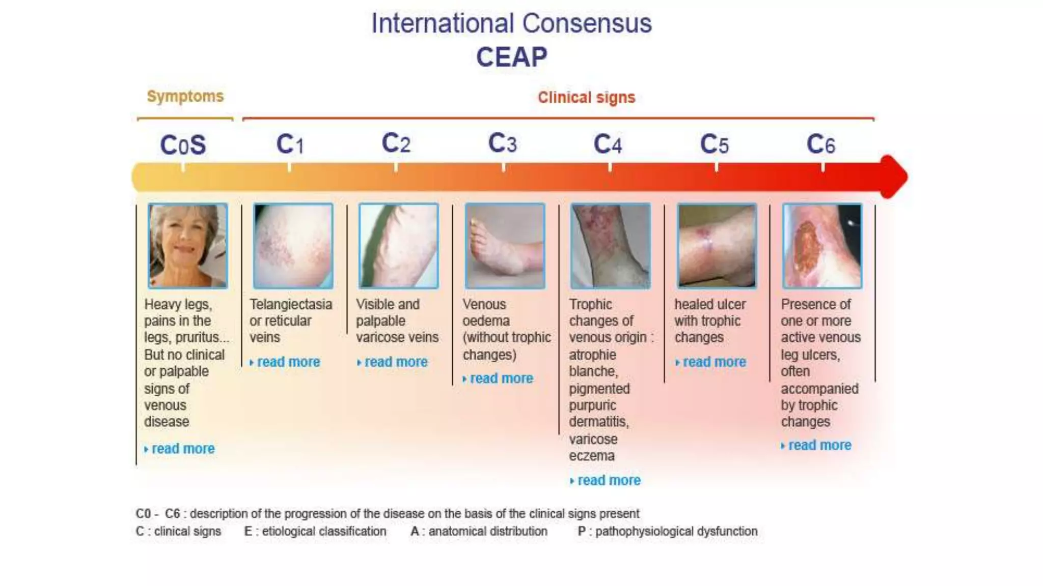 PPG and CDUS in venous reflux disease | PPTX