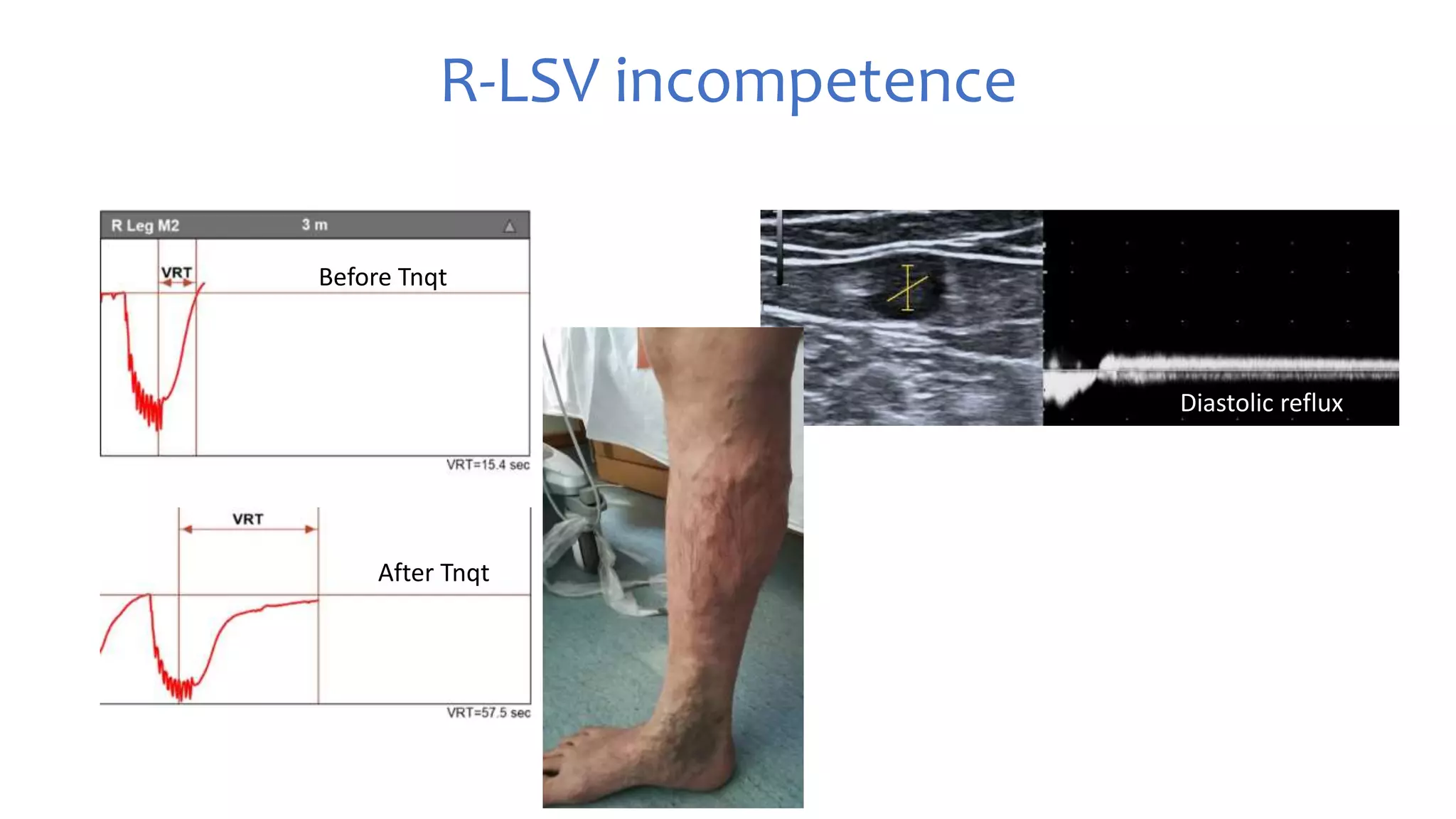 PPG and CDUS in venous reflux disease | PPTX