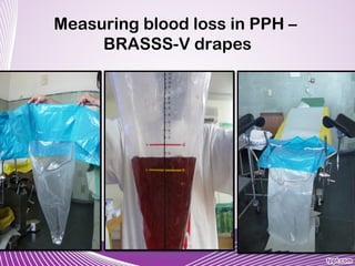 Post Partum Hemorrhage in ED | PPT