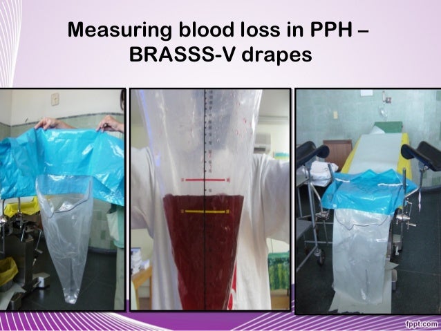 Post Partum Hemorrhage in ED