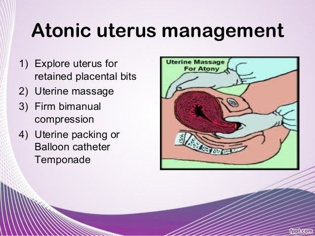 Post Partum Hemorrhage in ED
