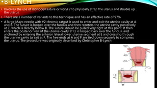 Post Partum Haemorrhage (B-Lynch, Stepwise uterine devascularization) | PPTX